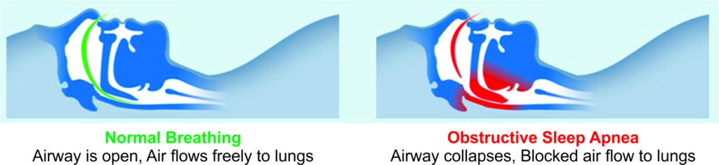 Sleep Apnea Crown Point - Oral Appliance - Advanced Dental Concepts