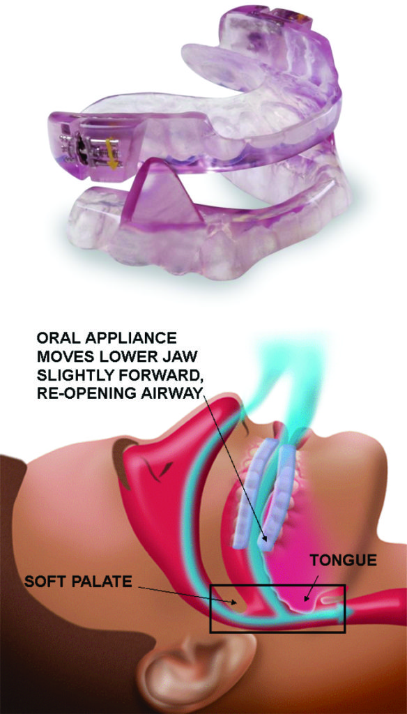Oral Appliance For Sleep Apnea Advanced Dental Concepts Blog
