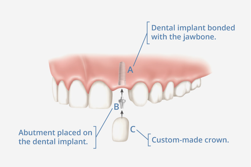What-is-an-implant - Advanced Dental Concepts Blog